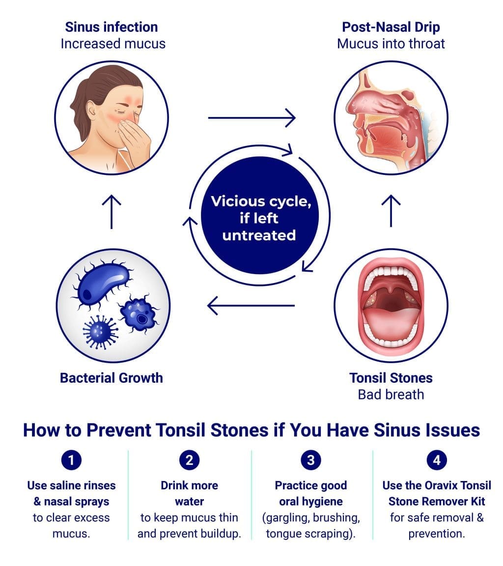 Can a sinus infection cause tonsil stones?